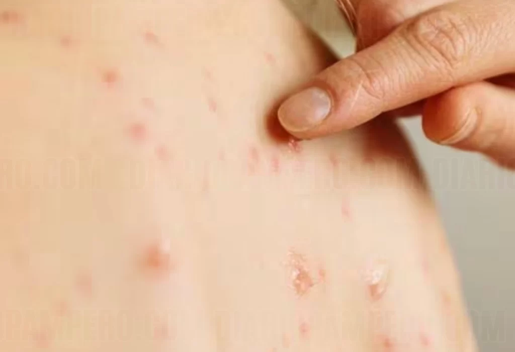 Alerta por brote de sarampión en Río Negro: Ocho casos confirmados sin ...